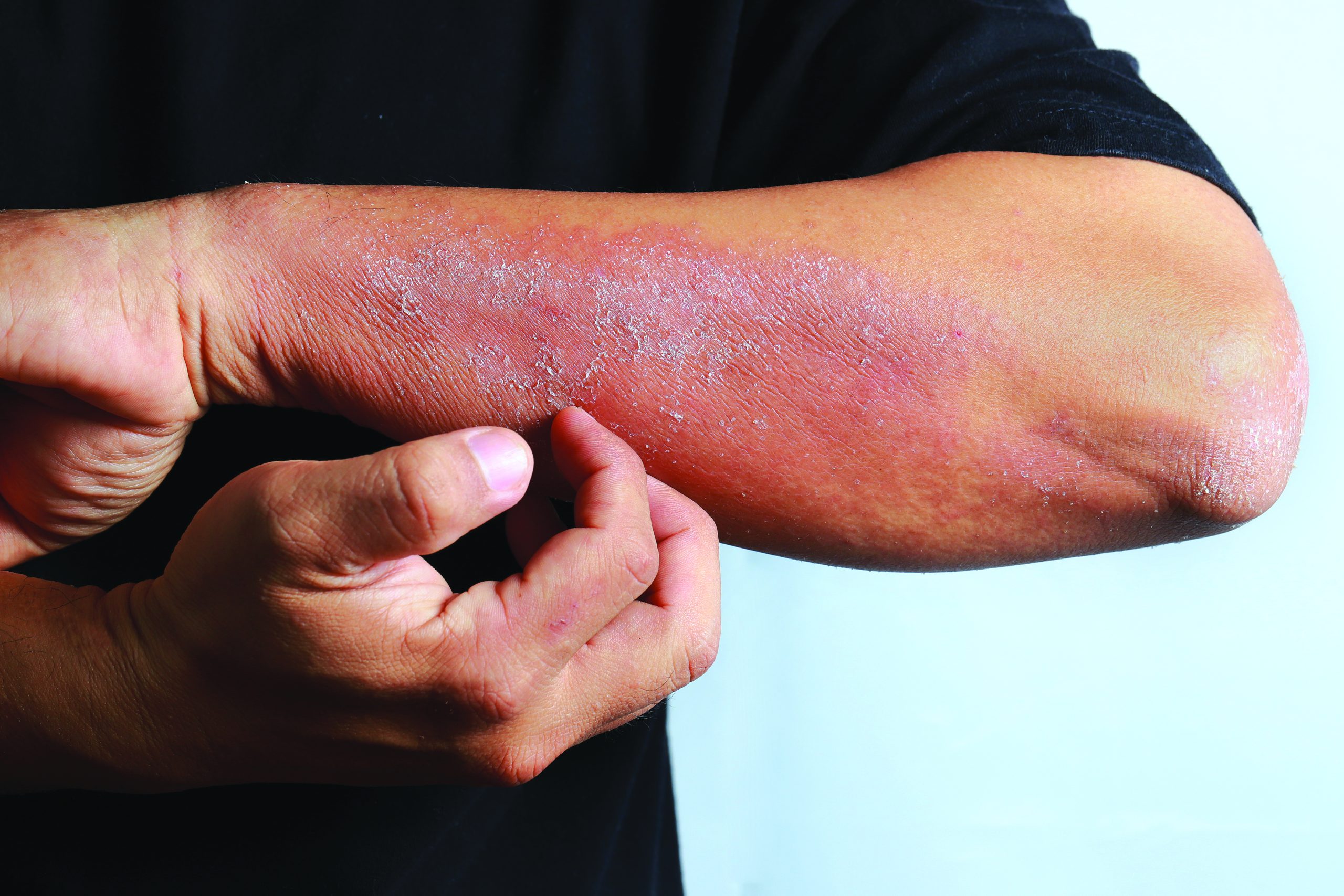 Eczéma - Association canadienne de dermatologie