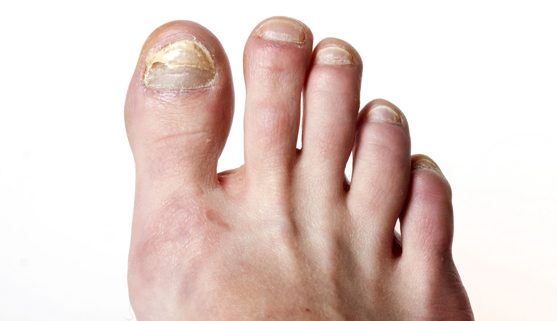 Champignons et infections - Association canadienne de dermatologie