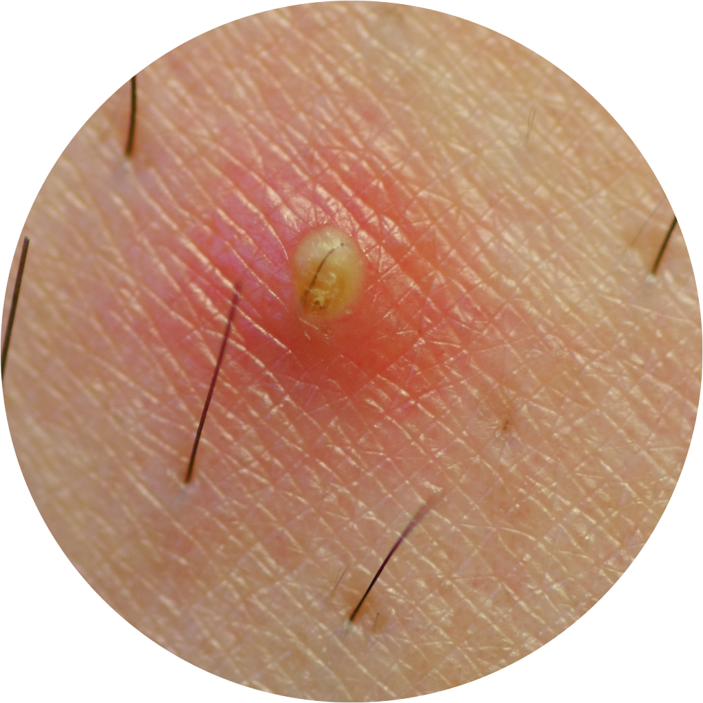 Poils incarnés - Association canadienne de dermatologie