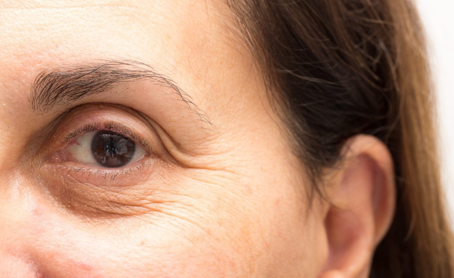 Photovieillissement - Association canadienne de dermatologie