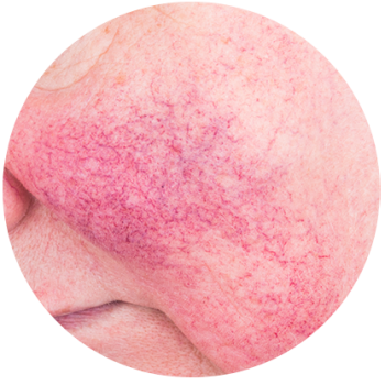 Affections cutanées - Association canadienne de dermatologie